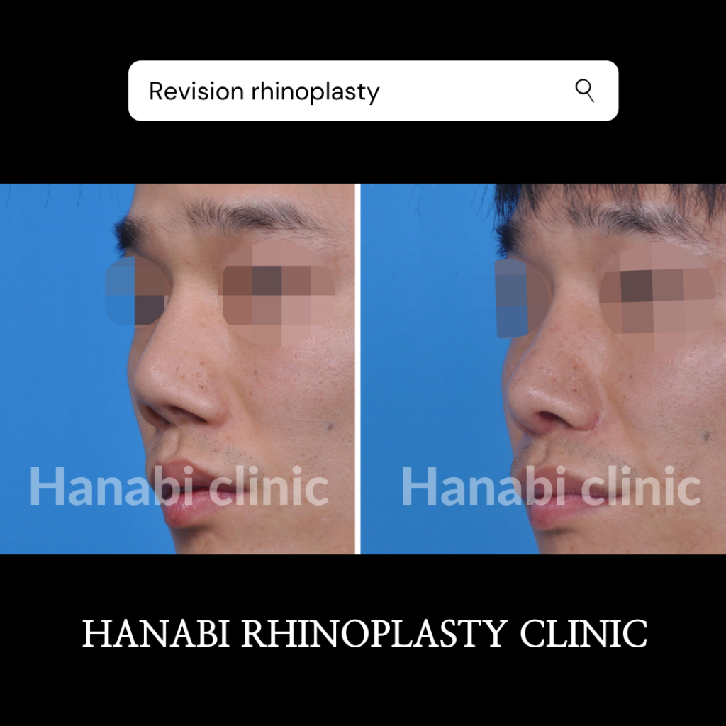 Before And After Of Photo Of The Deviated Nasal Columella Correction Hanabi Rhinoplasty Clinic