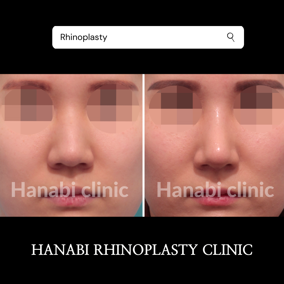 Before & after photo of woman hump nose correction – HANABI RHINOPLASTY CLINIC