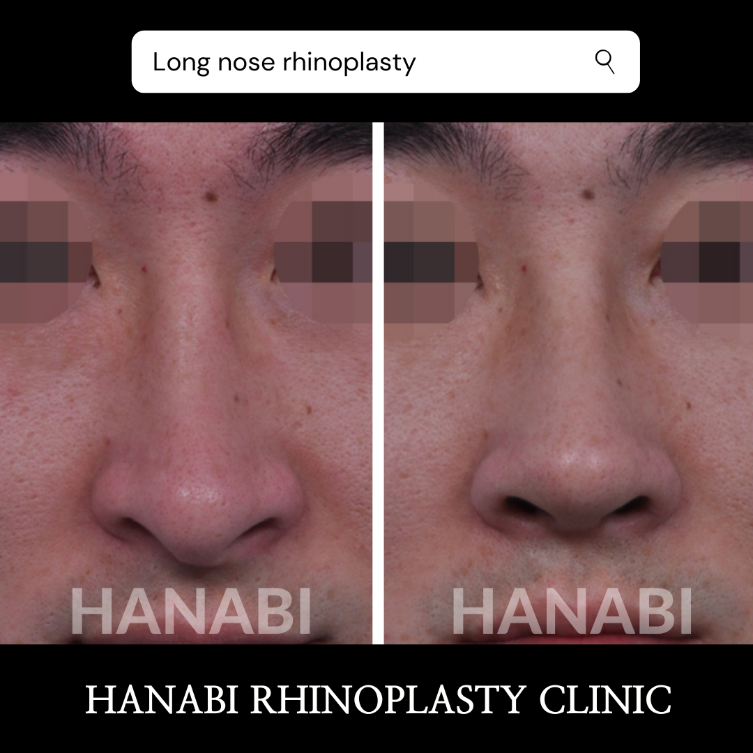 Long Nose Rhinoplasty For The Golden Facial Ratio Hanabi Rhinoplasty