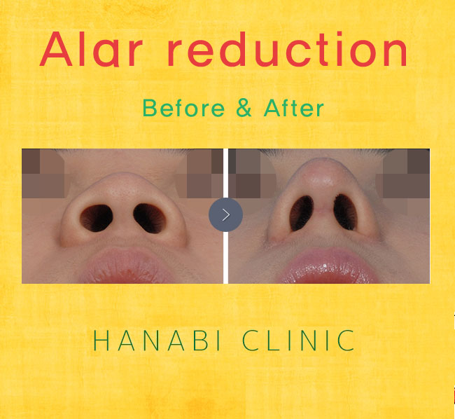 Alar reduction surgery – HANABI RHINOPLASTY CLINIC