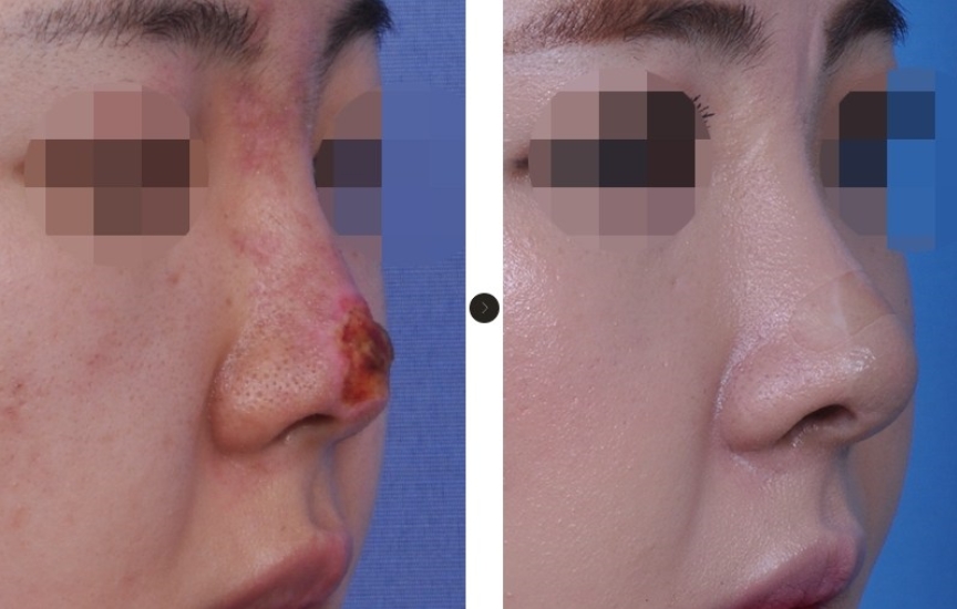 Skin Necrosis After Nose Filler Injection Hanabi Rhinoplasty Clinic