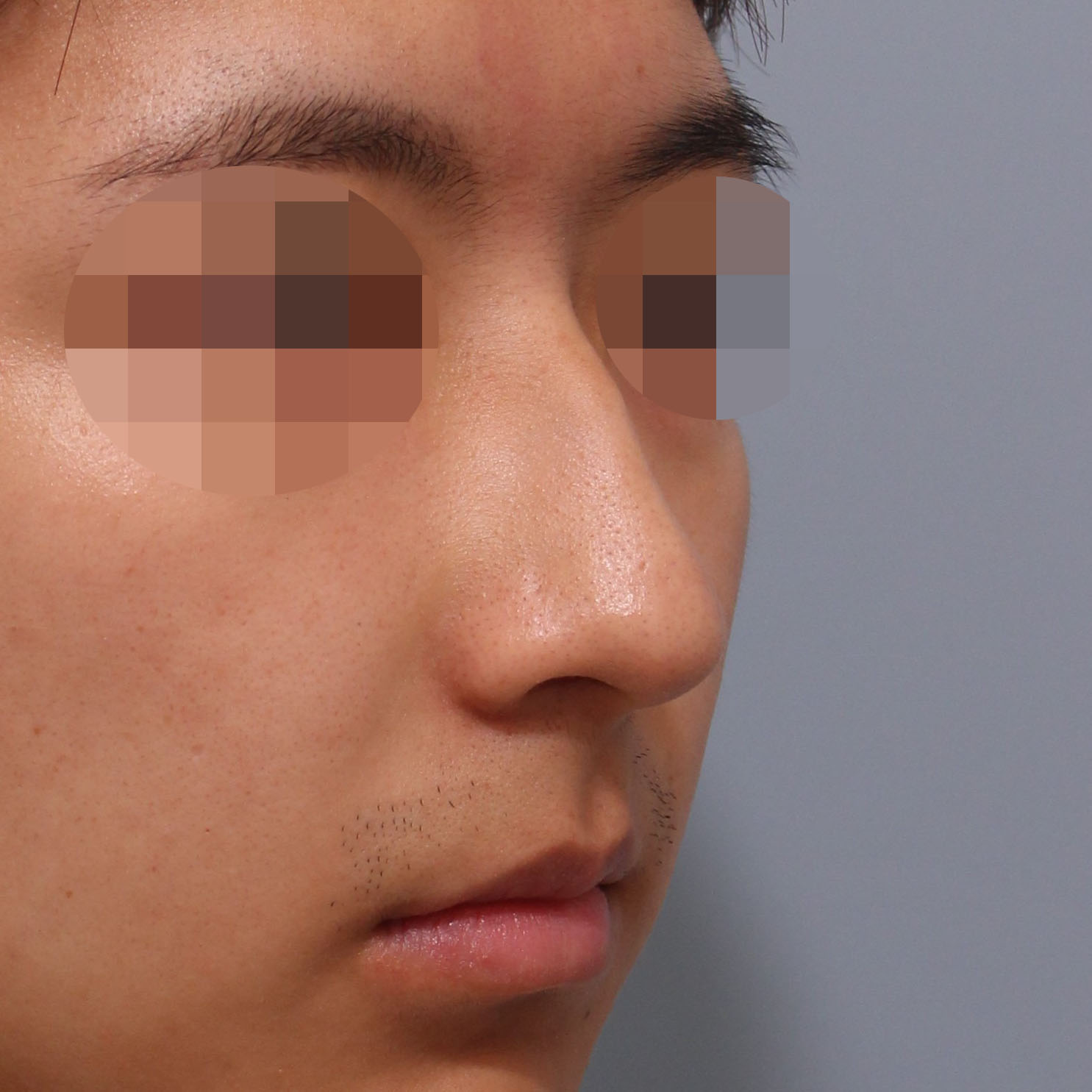 Hump Nose Rhinoplasty (nose job) before and after – HANABI RHINOPLASTY CLINIC