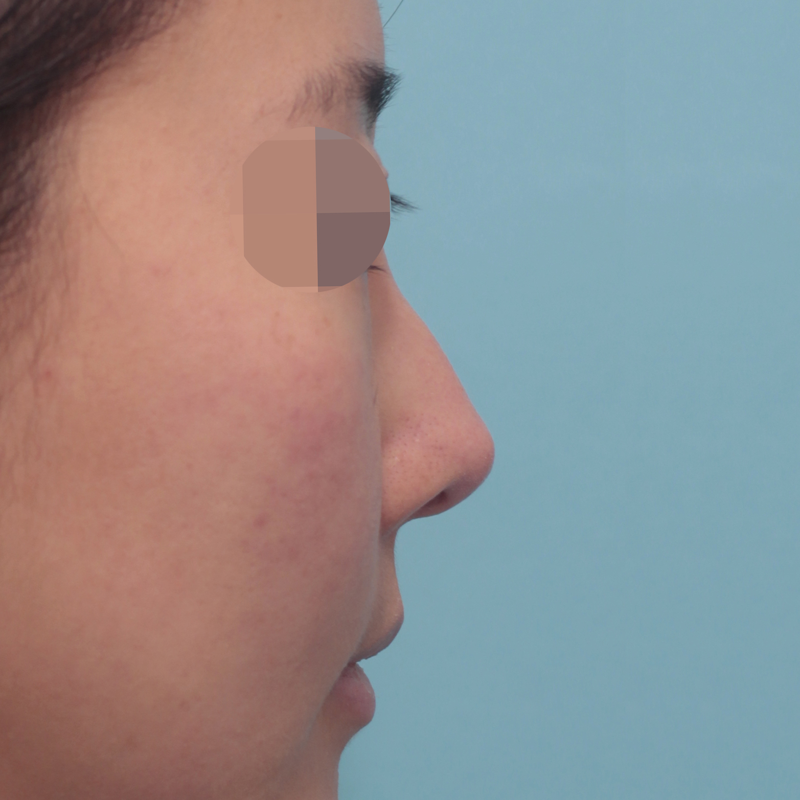 Asian nasal bridge augmentation before and after – HANABI RHINOPLASTY CLINIC